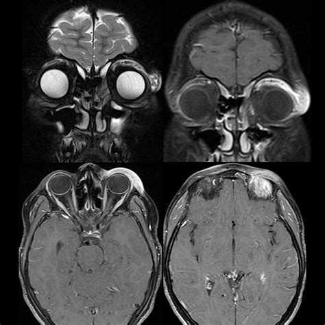 Pediatric Dacryoadenitis Pediatric Radiology Reference Article Pediatric Imaging Pedsimaging
