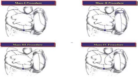 Versions Of The Surgical Maze Procedure [13] Download Scientific Diagram