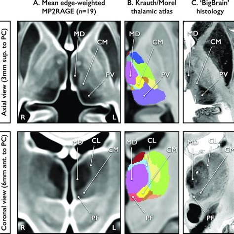 Pdf Targeting The Centromedian Thalamic Nucleus For Deep Brain