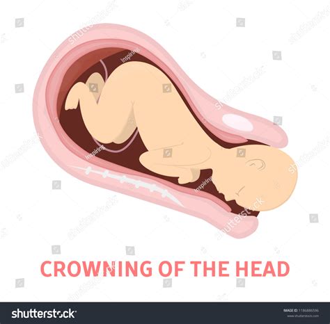 Graphic Vaginal Birth Crowning Stage Of Vaginal Delivery Flat