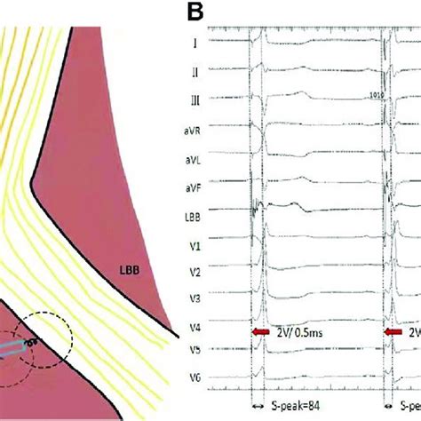 A Schematic Diagram Of Continuous Pacing At Low Output 2 V 05 Ms