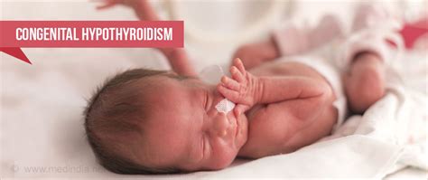 Congenital Hypothyroidism Cretinism Causes Symptoms Diagnosis Treatment