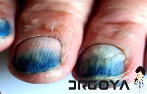 بیماری ناخن و انواع آن شناسایی و درمان دکتر گویا👨‍⚕️