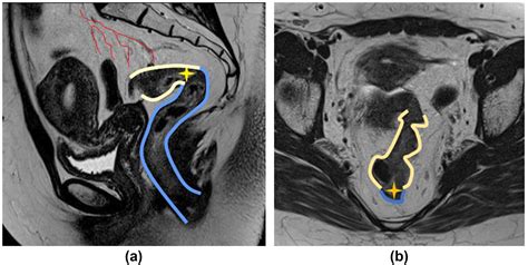 “sigmoid Take Off” To Define Recto Sigmoid Junction And Its Impact On Rectal Cancer