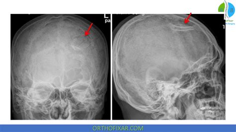 Linear Fracture X Ray