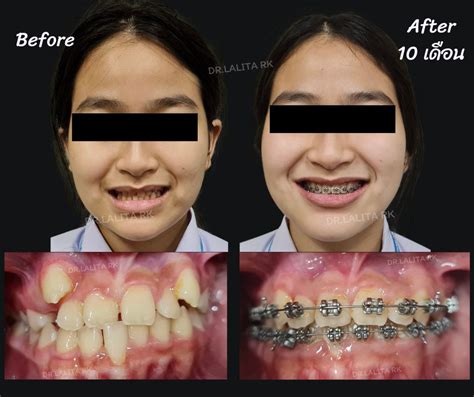 จัดฟันแก้ฟันซ้อนเก ด้วยเทคนิคเฉพาะ