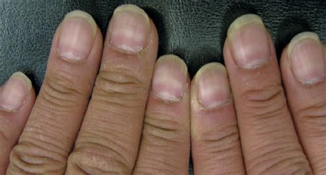 White Lines Across Big Toenails Nail Ftempo
