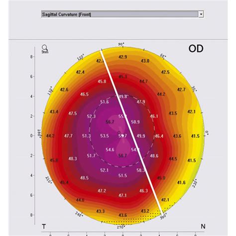 Pentacam For The Same Eye Axial Map A Shows Peripheral Cone And