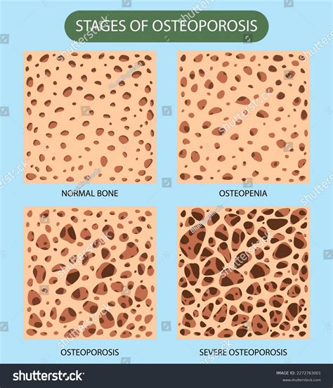 Bone Density Osteoporosis Vector Illustration Stock Vector Royalty Free 2272763001 Shutterstock