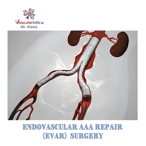 Complex Endovascular Repair Of Aortic Aneurysms