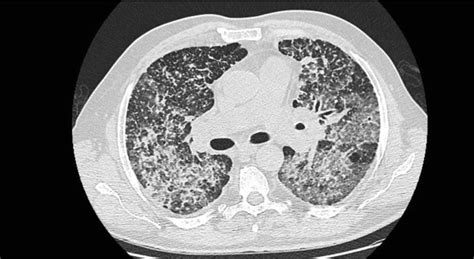 Pulmonary Histoplasmosis Clinical And Imagistic Characteristics
