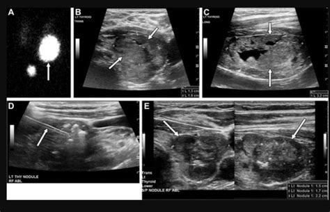 Photo Gallery What Do Thyroid Nodules Look Like On Imaging