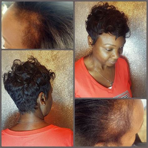 Pin On Disorders Of The Scalp Hair