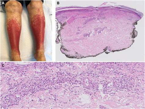 Leukocytoclastic Vasculitis Cutaneous Small Vessel Vasculitis After