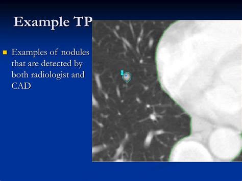 Ppt Cad Performance Analysis For Pulmonary Nodule Detection Comparison Of Thick And Thin