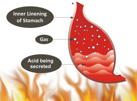 Natural Cure For Burning Sensation In Stomach