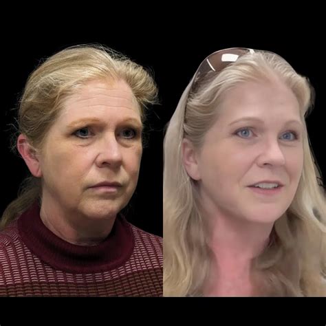 Bio Identical Hormone Replacement Therapy Maryland Plastic Surgery