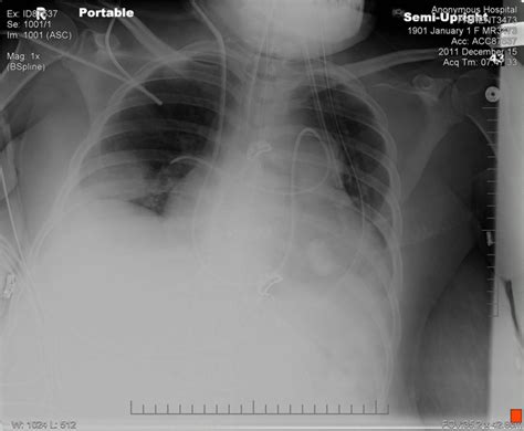 Pulmonary Artery Catheter Coiled In The Main Pulmonary Artery Trunk