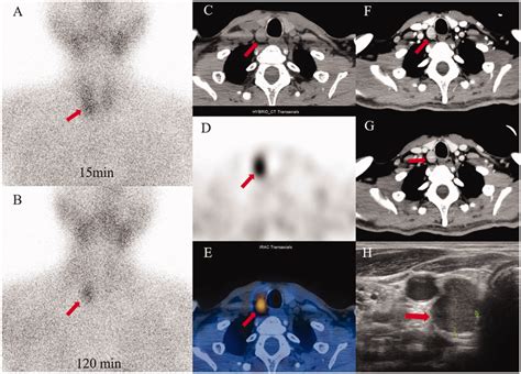 A Technetium 99m Sestamibi 99mtc Mibi Scintigraphy Showed Focal Download Scientific Diagram
