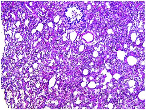 Lung Microscopy Infiltration Of The Bronchial Wall With Lymphocytes Download Scientific