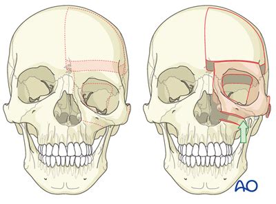 Four Wall Box Osteotomy For Pruzansky Iia