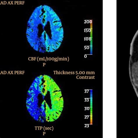 Non Contrast Brain Ct Shows Evidence Of Encephalomalacia And Old