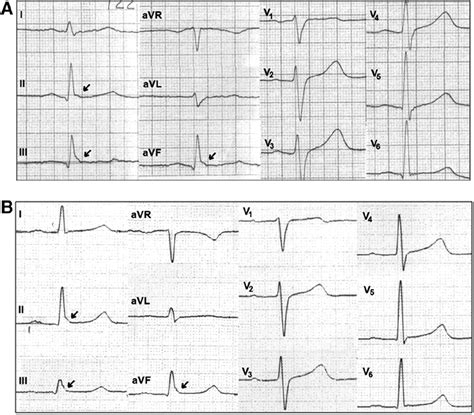 Early Repolarization Vs Stemi