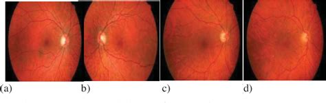 Figure 1 From Automated Classification Of Glaucoma Using Dwt And Hog