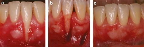 Coverage Of A Miller Class Ii Recession Using A Lateral Sliding Flap A Download Scientific