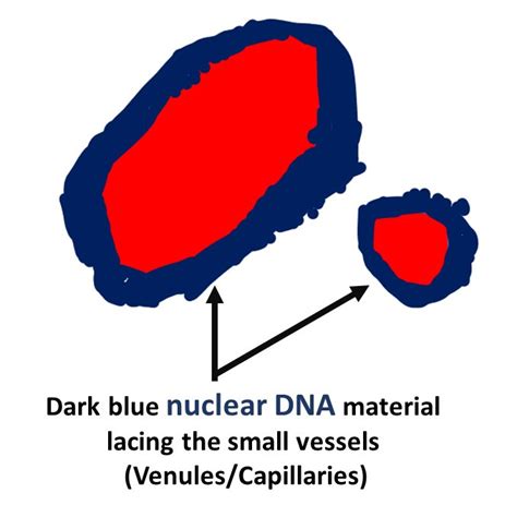 Plexiform Pattern Patternsinhistopathology Pathology Made Simple