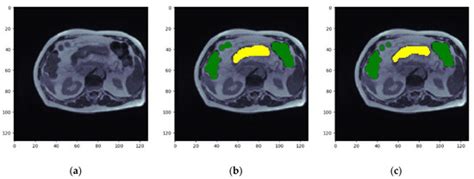 Efficientnetb0 Cum Fpn Based Semantic Segmentation Of Gastrointestinal Tract Organs In Mri Scans