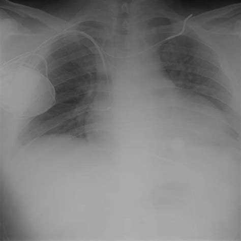 Defibrillation Lead Placed In The Azygous Vein The Patient Failed To Download Scientific