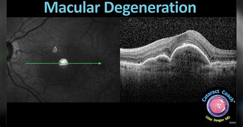 Oct Screening Needed Before Cataract Surgery