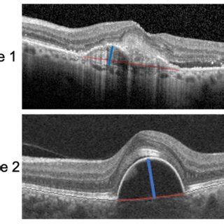 SD OCT Scan Of Two Patients With A PED The Red Lines Correspond To The Download Scientific