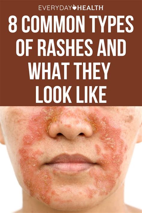 8 Common Types Of Rashes And What They Look Like Types Of Rashes