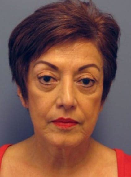 Fat Transfer Surgery For Facial Aging Newport Beach