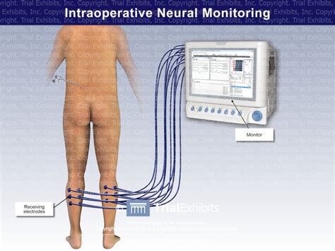 Intraoperative Neural Monitoring Trialquest Inc