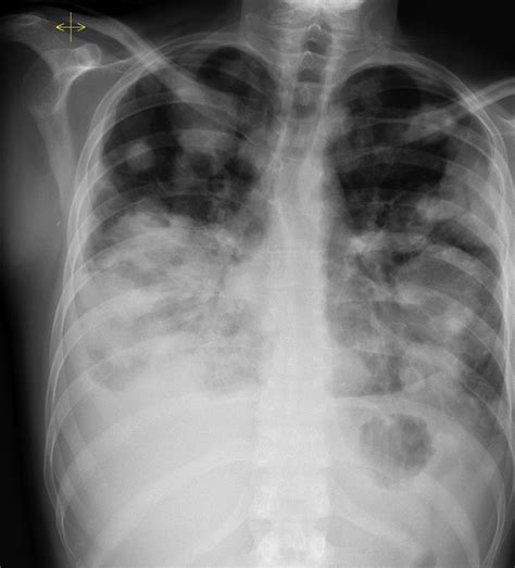 Lung Metastases Radiology At St Vincents University Hospital