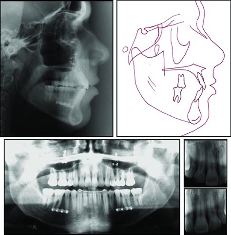 Posttreatment Lateral Radiograph Lateral Cephalometric Radiograph And