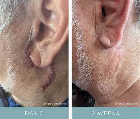 Squamous Cell Carcinoma Mohs Surgery Before After Photos