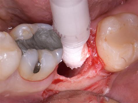 Open Healing Socket Preservation With And Without Implant Restoration