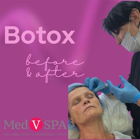 Botox Before And After Medvspa