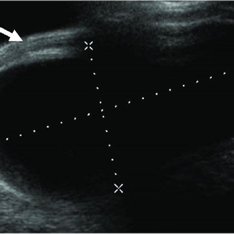 Pdf Endoscopic Decompression And Marsupialization Of A Duodenal Duplication Cyst