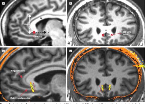 Posterior Cingulate Cortex Semantic Scholar