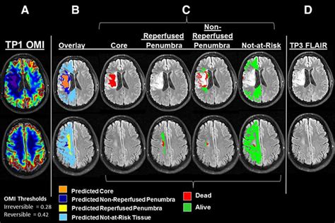 Ischemic Stroke Penumbra