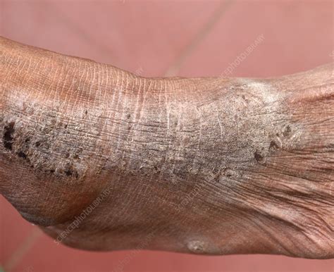 Lichenification In Eczema Stock Image C0372219 Science Photo Library