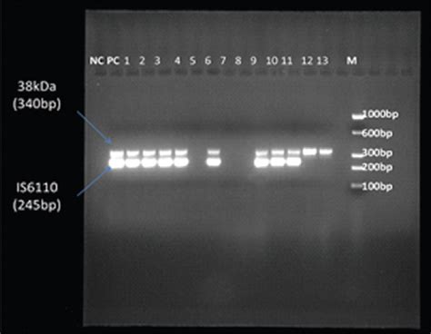 Role Of Multiplex Polymerase Chain Reaction In Diagnosing Tubercular Meningitis Journal Of