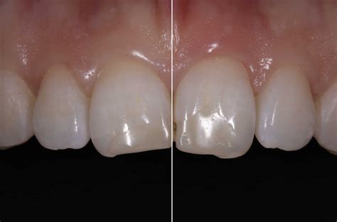 Class Iv Restoration Replacement Myzerodonto