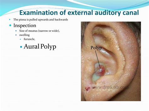 Otitis Externa Furuncle