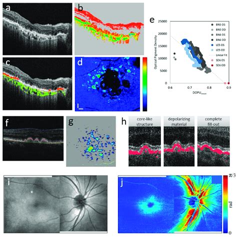 Ps Oct In The Posterior Eye Ad Ps Oct Of A Patient With Late Stage